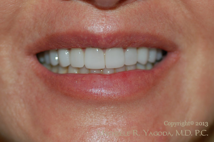Patient 4 Dr Michelle Yagoda NYC Facial Plastic Surgeon Patient 4 Dr Michelle Yagoda NYC Facial Plastic Surgeon